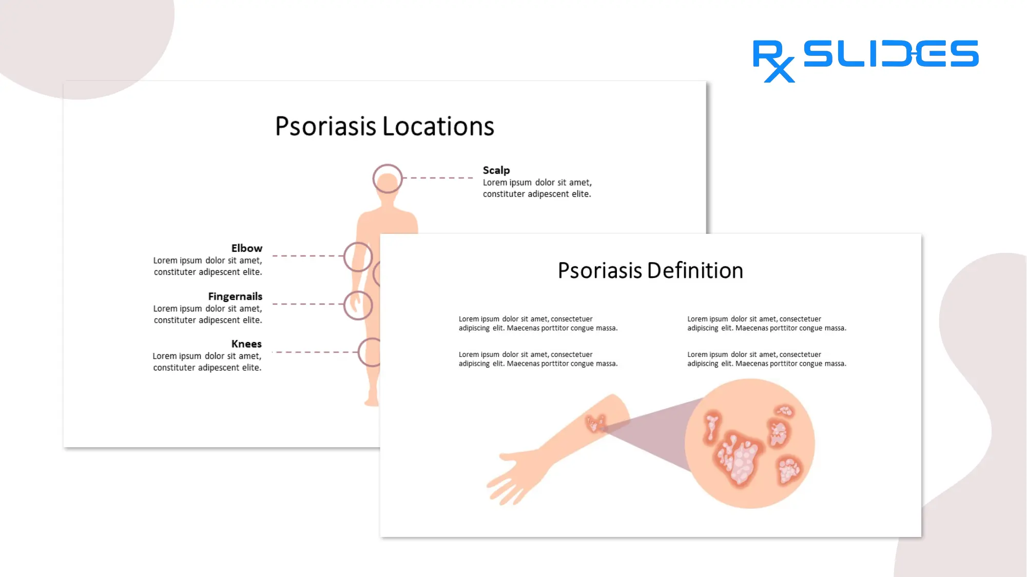 Download Psoriasis PowerPoint Template|